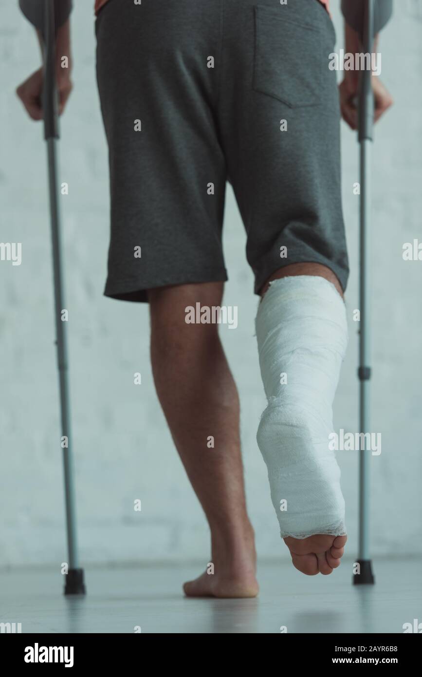 Leg in plaster hi-res stock photography and images - Alamy