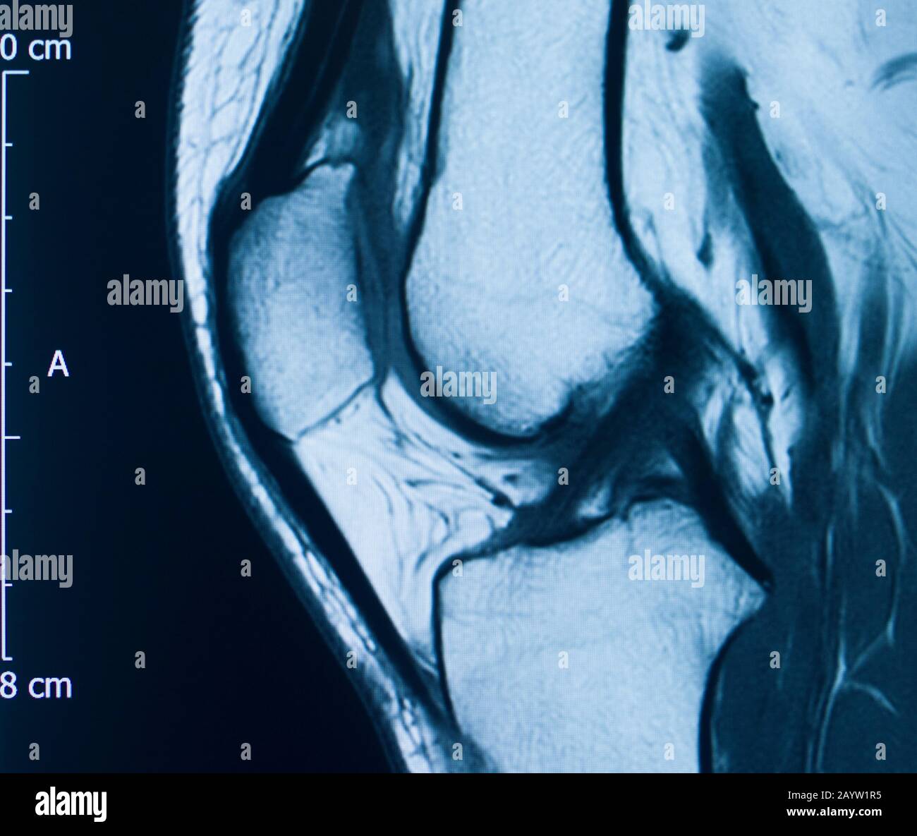 Knee sports injury mri mcl grade 2 tear magnetic resonance imaging ...