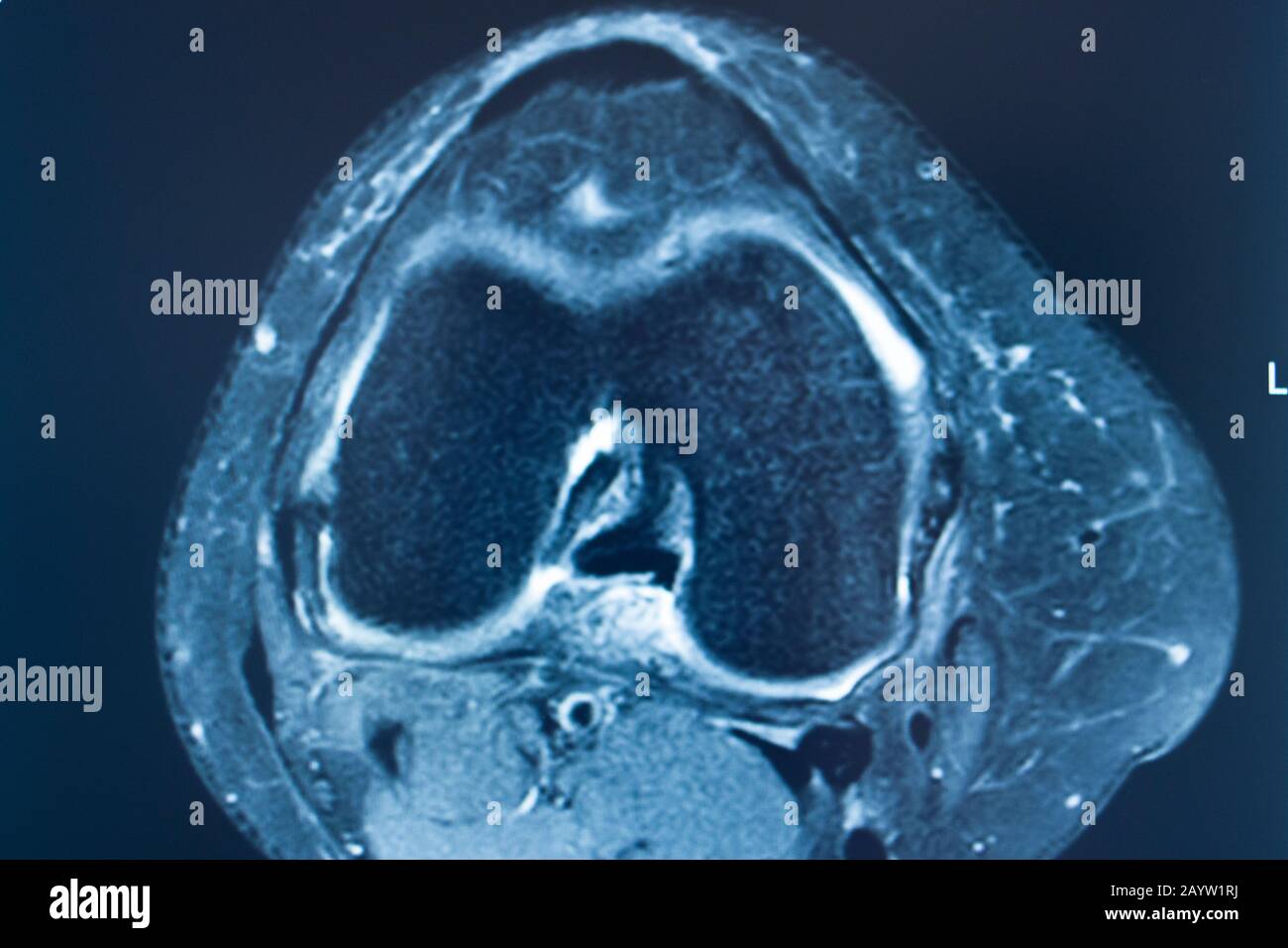 Knee sports injury mri mcl grade 2 tear magnetic resonance imaging ...