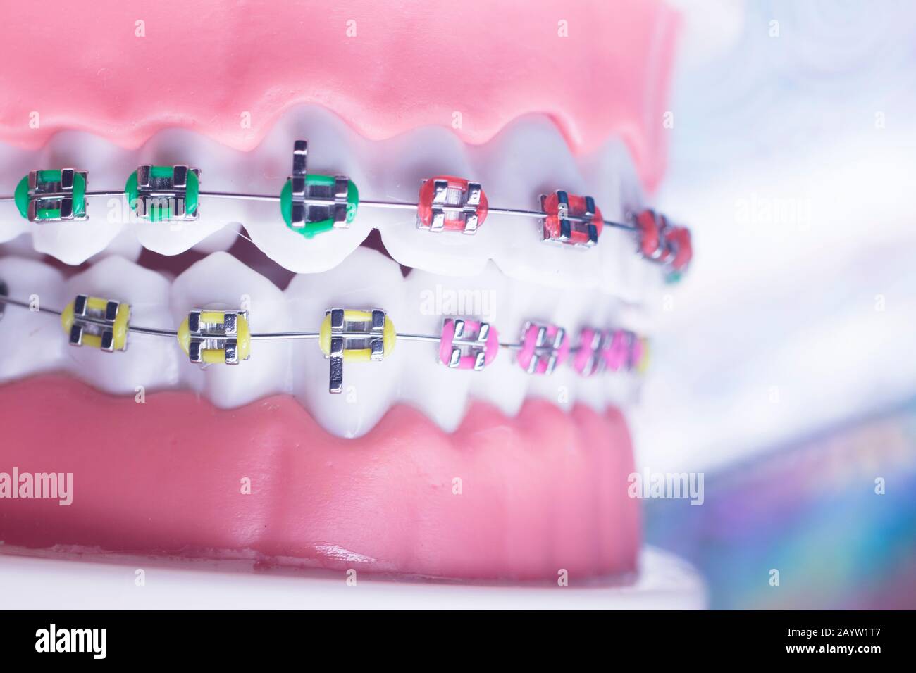 Modern metal retainers and plastic algners wire dental brackets teeth ...