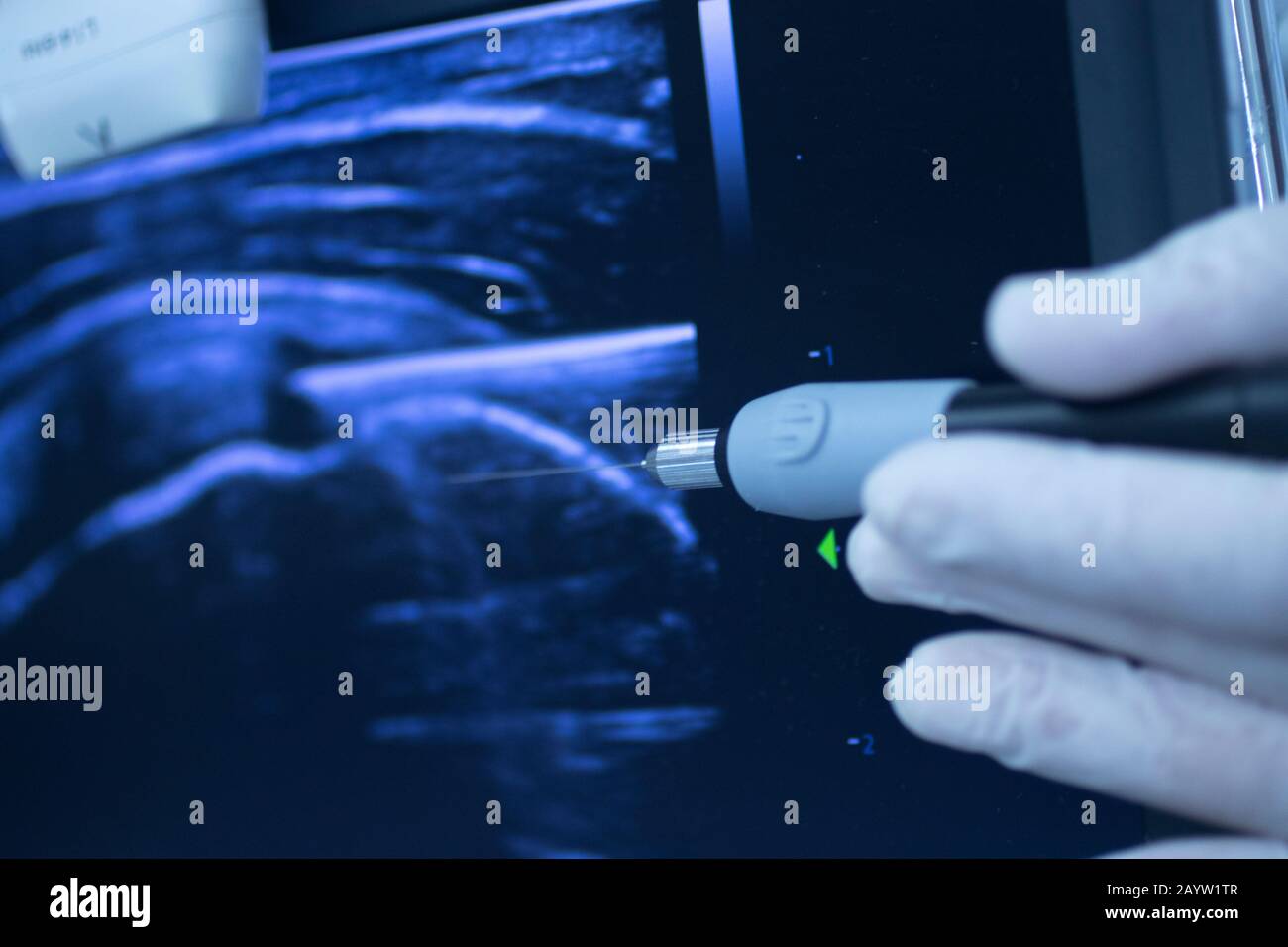EPI Intratissue Percutaneous Electrolysis dry needling ultrasound ...