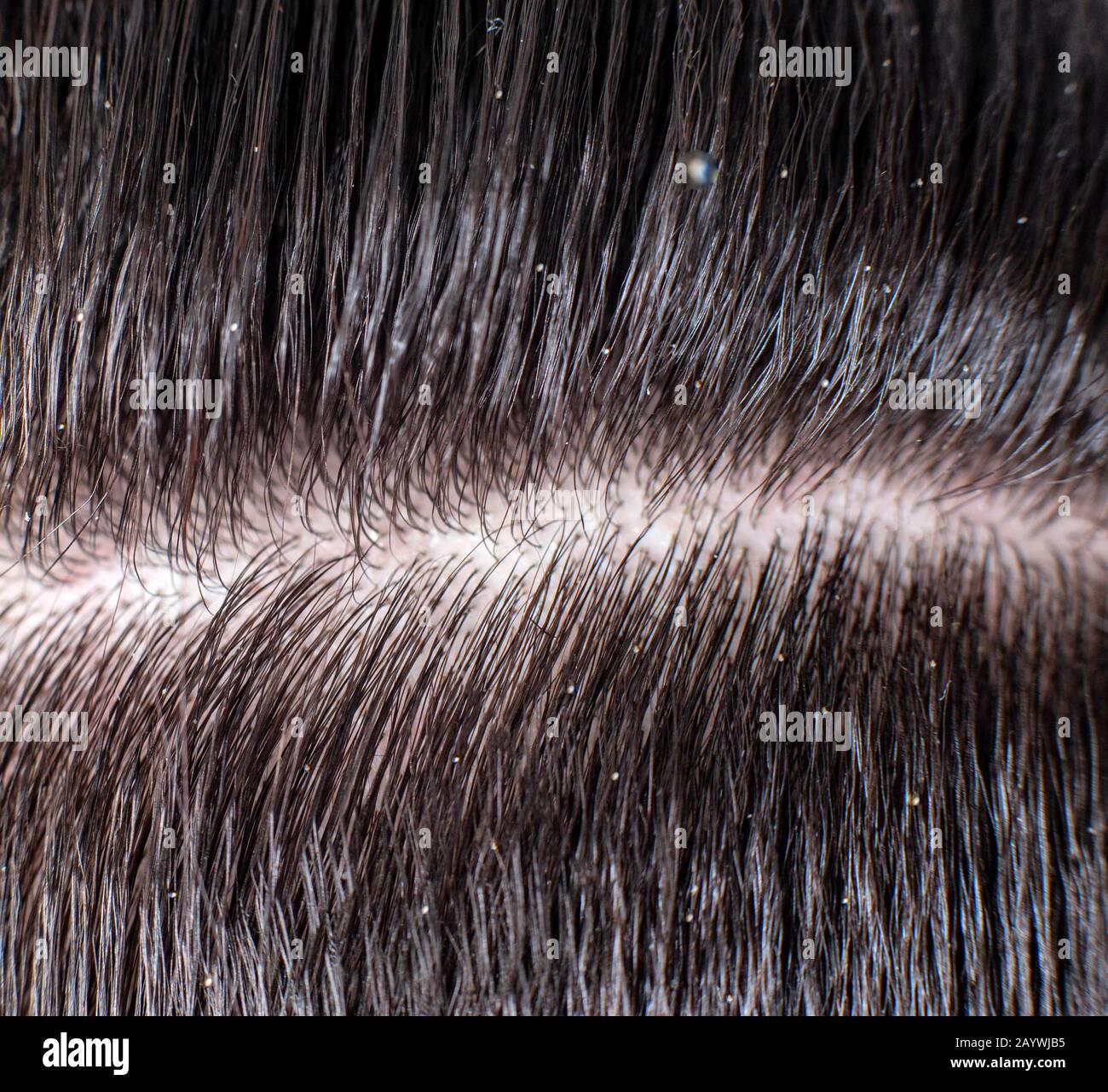 Malassezia hi-res stock photography and images - Alamy