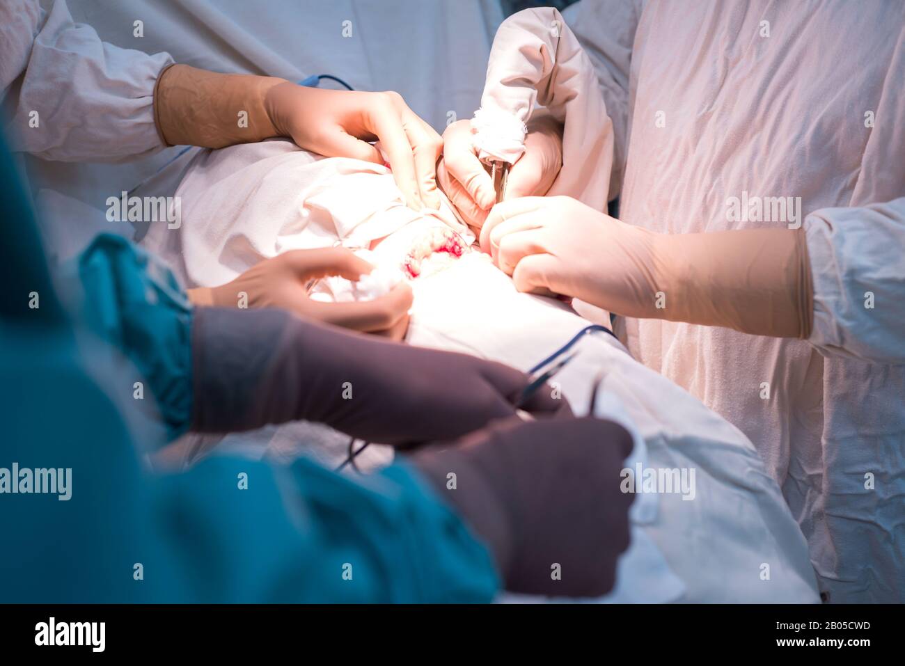 team of surgeons doing an operation. Sterile operating room. Kidney ...