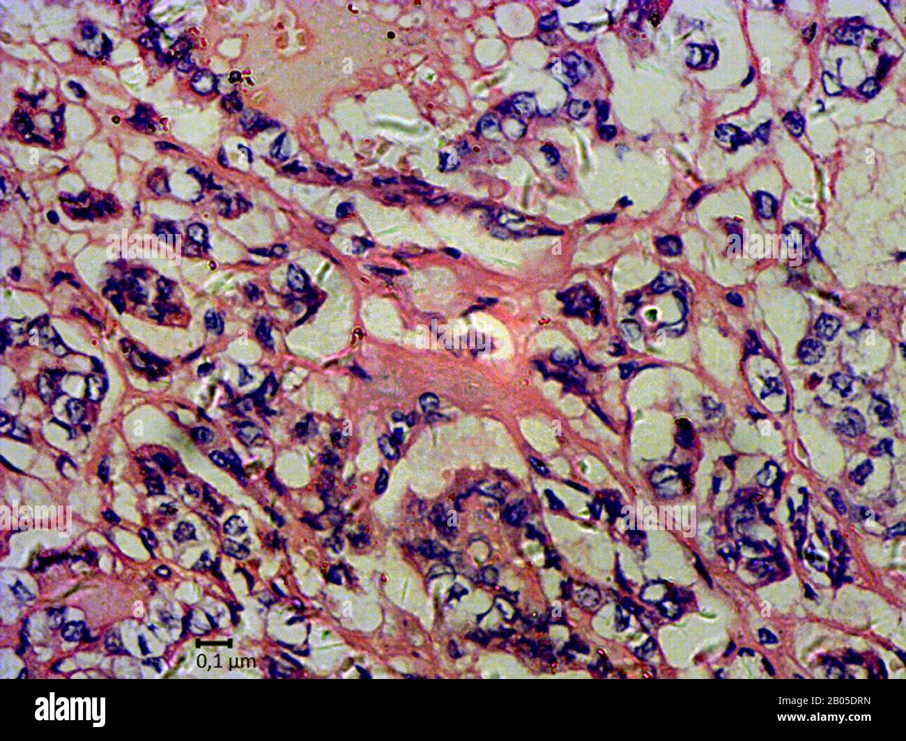 Thyroid cancer hi-res stock photography and images - Alamy