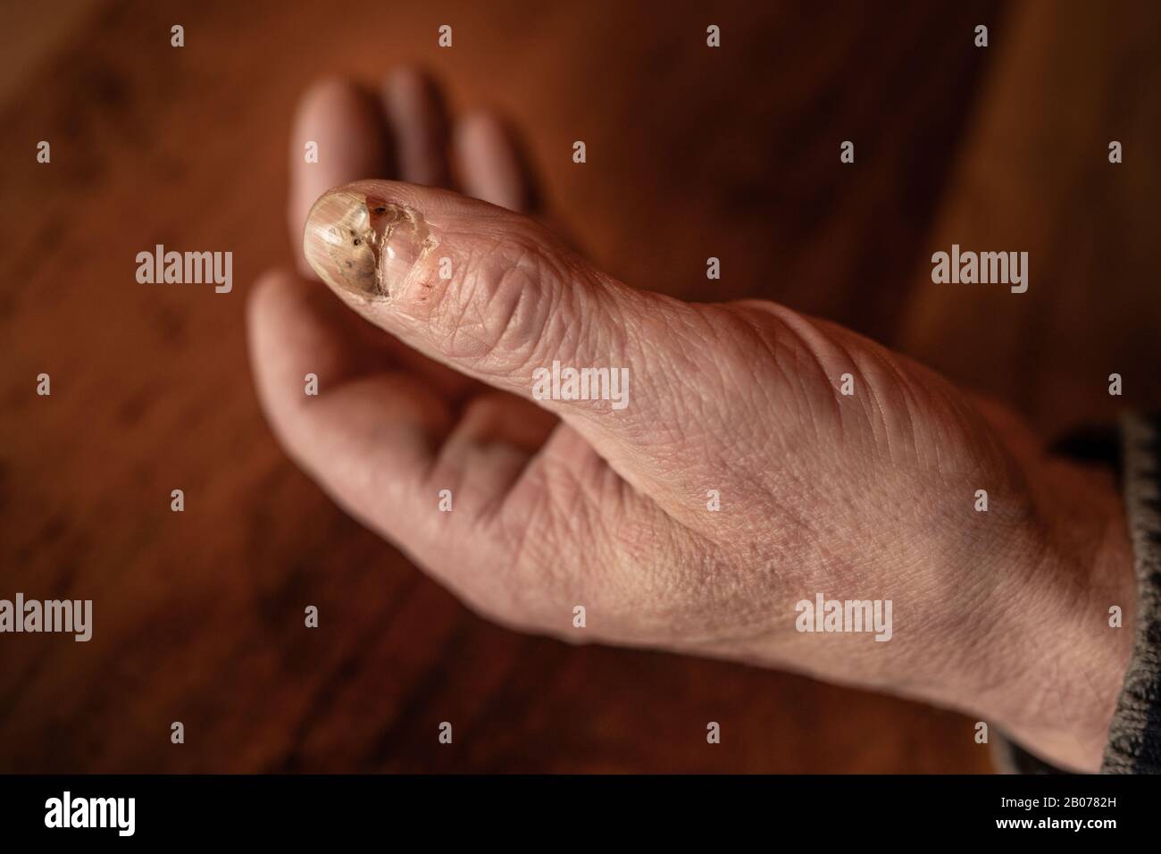 Smashed thumb hi-res stock photography and images - Alamy