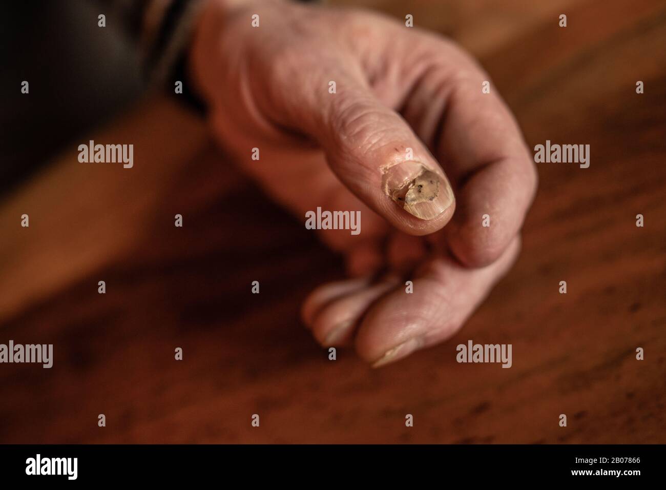 Smashed thumb hi-res stock photography and images - Alamy