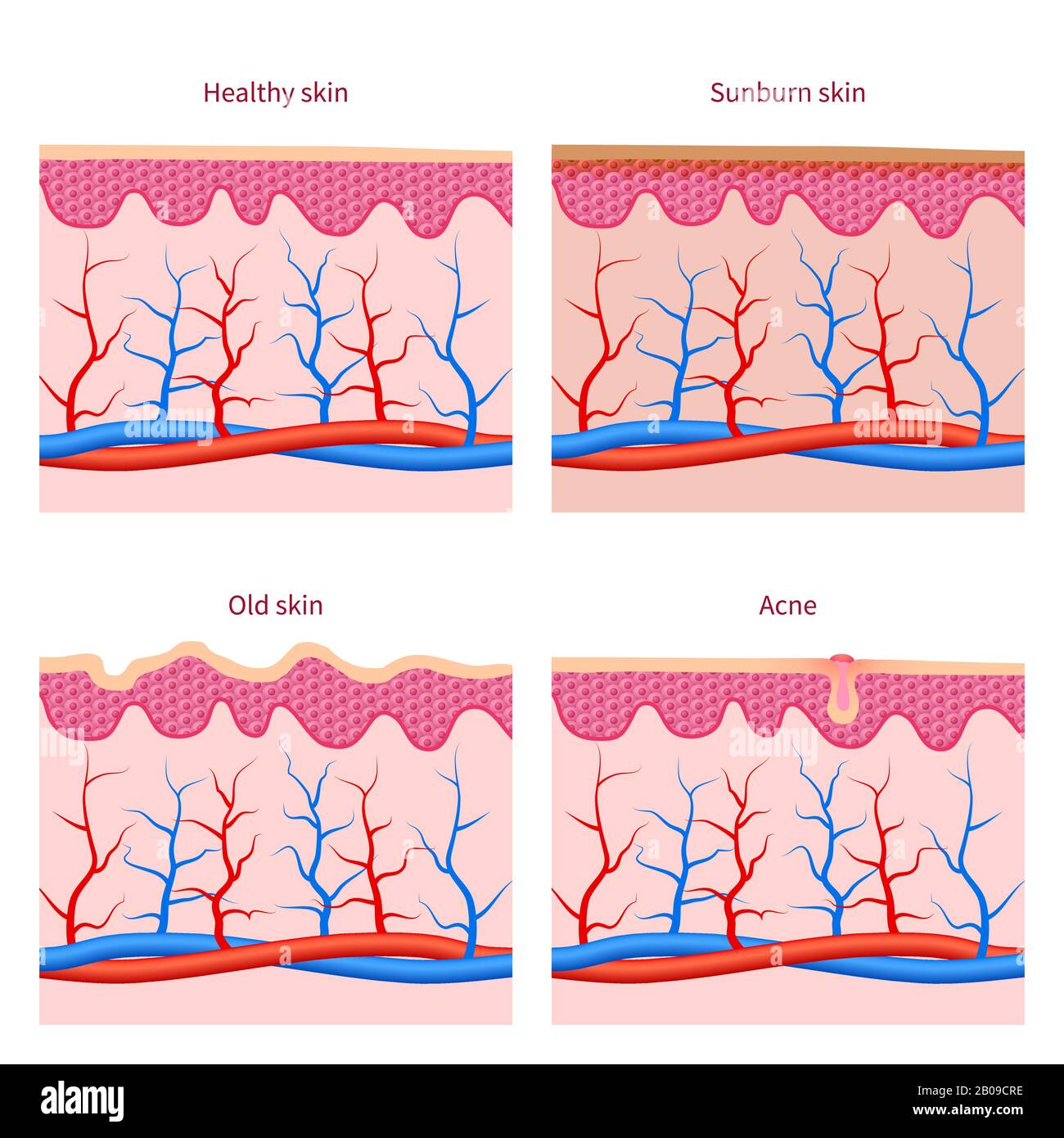 Skin Types And Healthy Sunburn And Old Skin Acne Vector Set Human