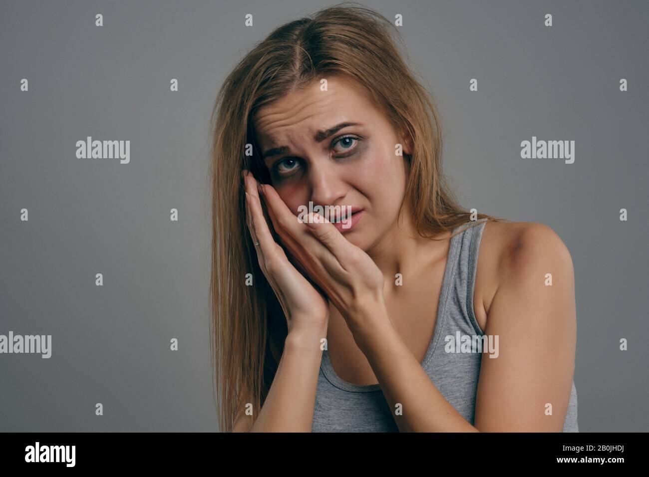 Bruises hi-res stock photography and images - Alamy