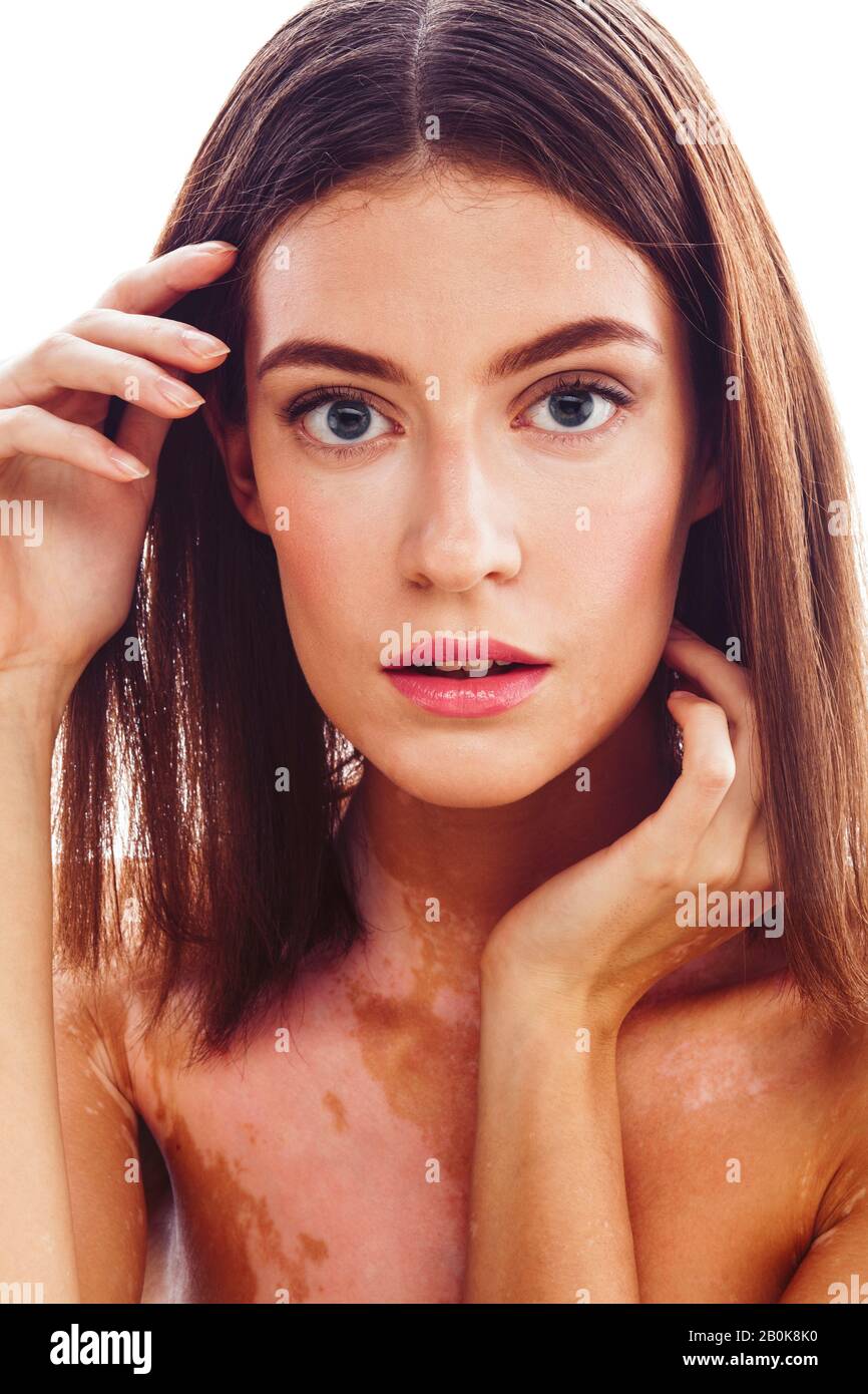 beautiful young brunette woman with vitiligo disease close up isolated ...
