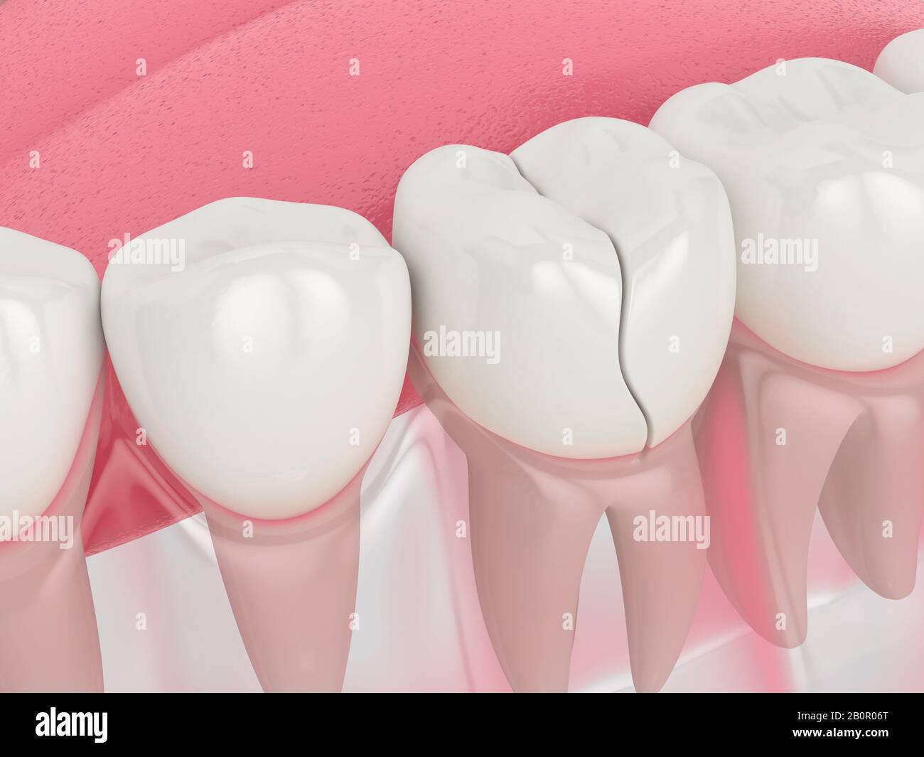 3d render of jaw with treatable cracked tooth over white background ...