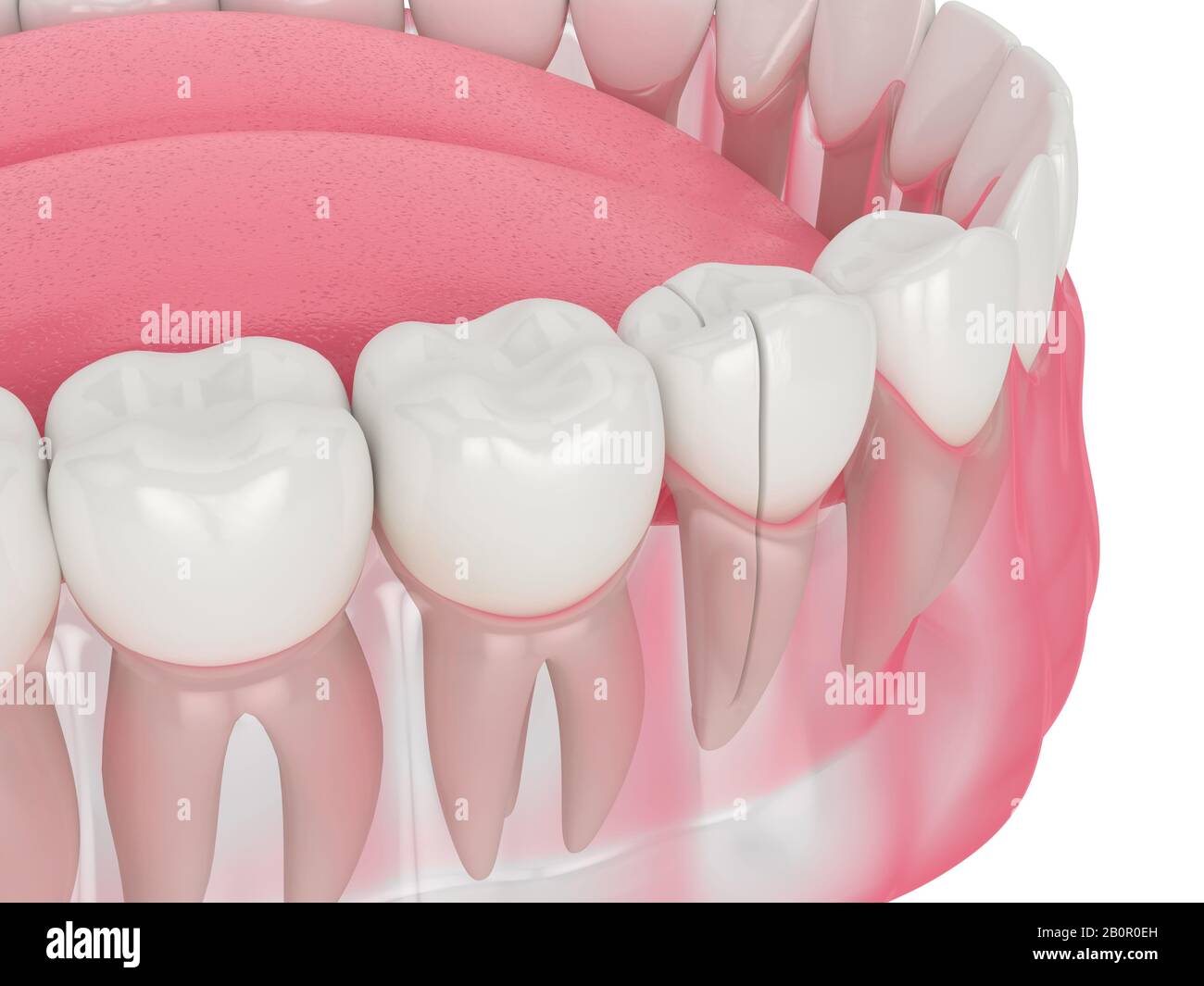 3d render of jaw with split tooth over white background. Types of ...