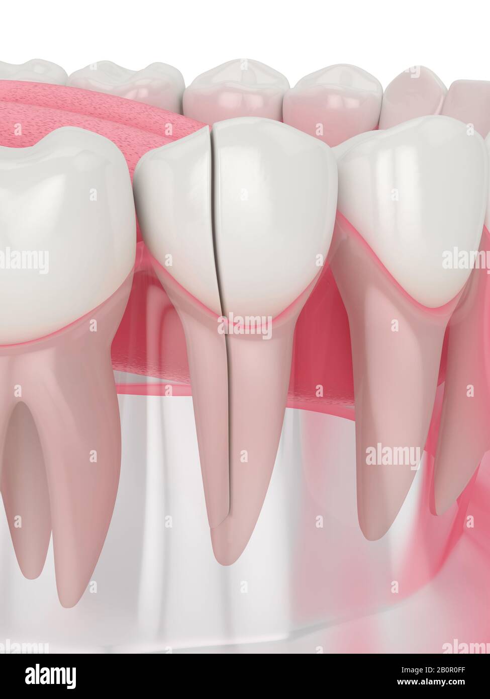 3d render of jaw with split tooth over white background. Types of ...