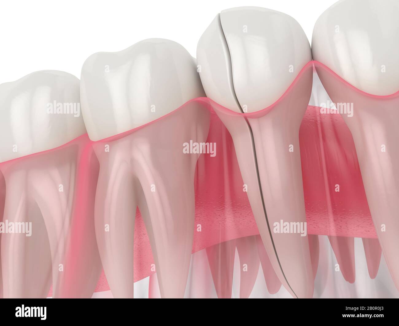 3d render of jaw with split tooth over white background. Types of ...