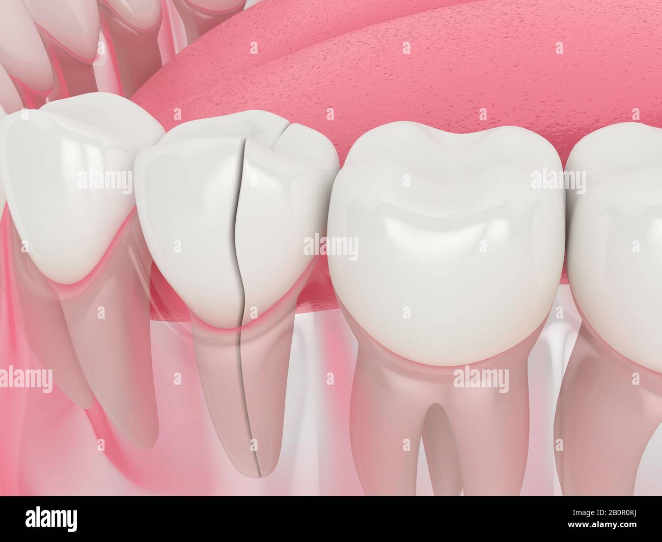 3d render of jaw with split tooth over white background. Types of ...