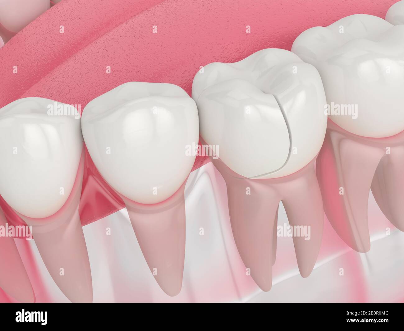 Broken teeth hi-res stock photography and images - Alamy