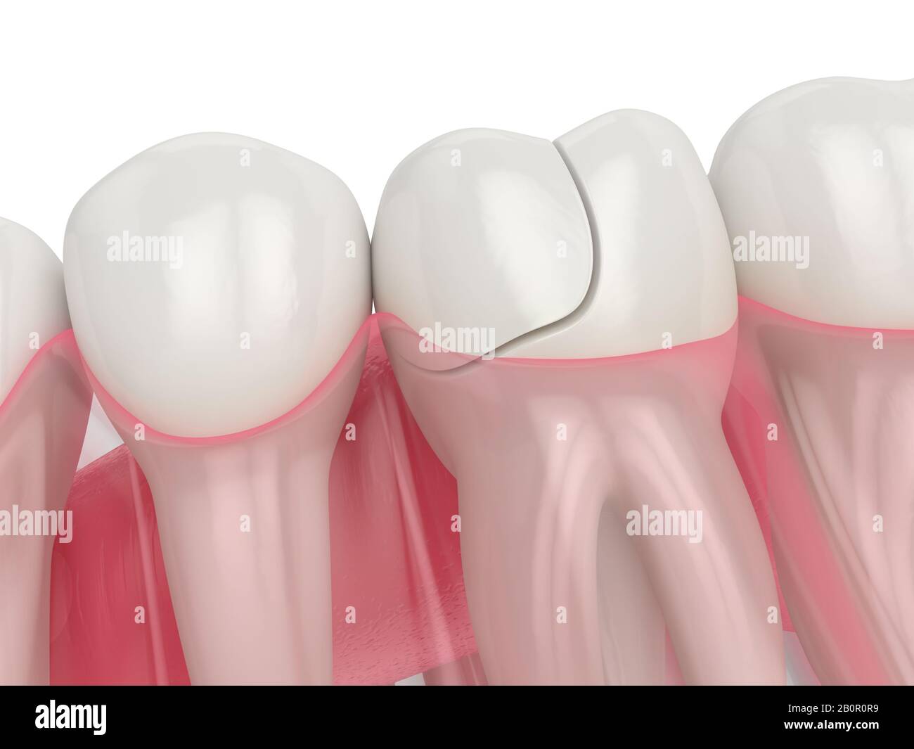 3d render of jaw with fractured tooth over white background. Types of ...