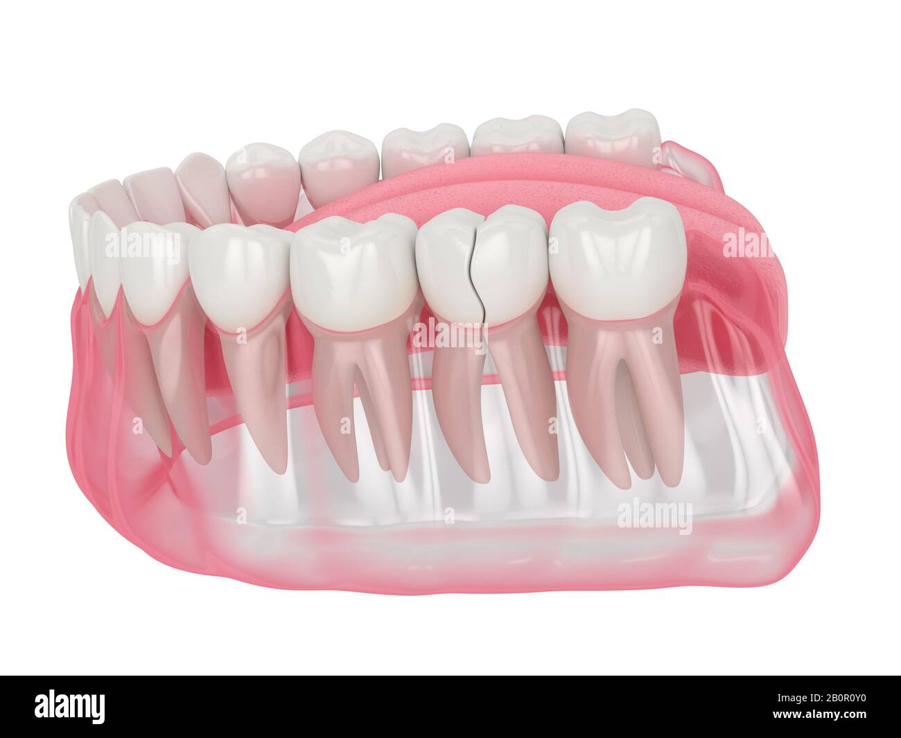 3d render of jaw with nontreatable cracked tooth over white background ...
