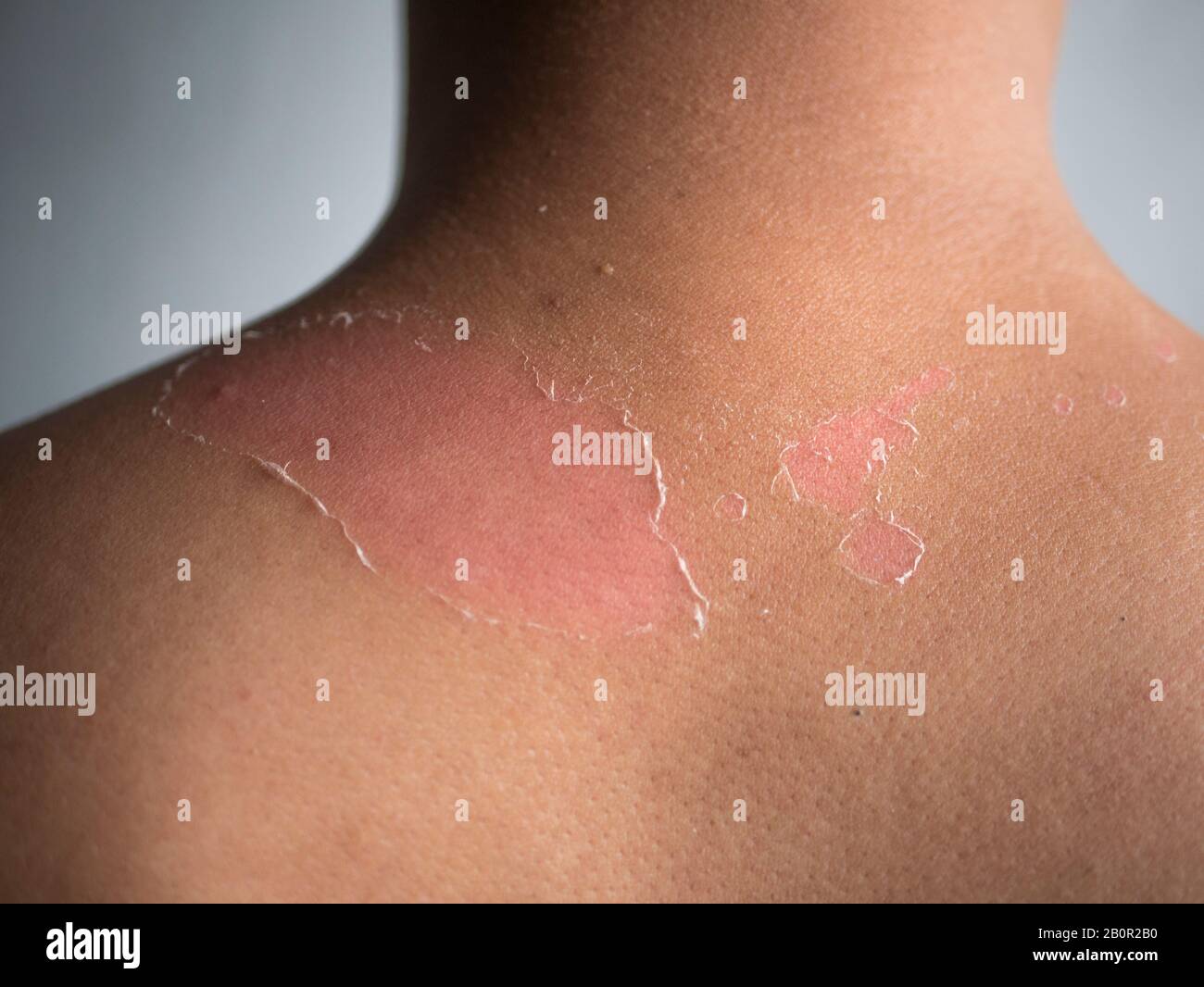Peeling skin hi-res stock photography and images - Alamy