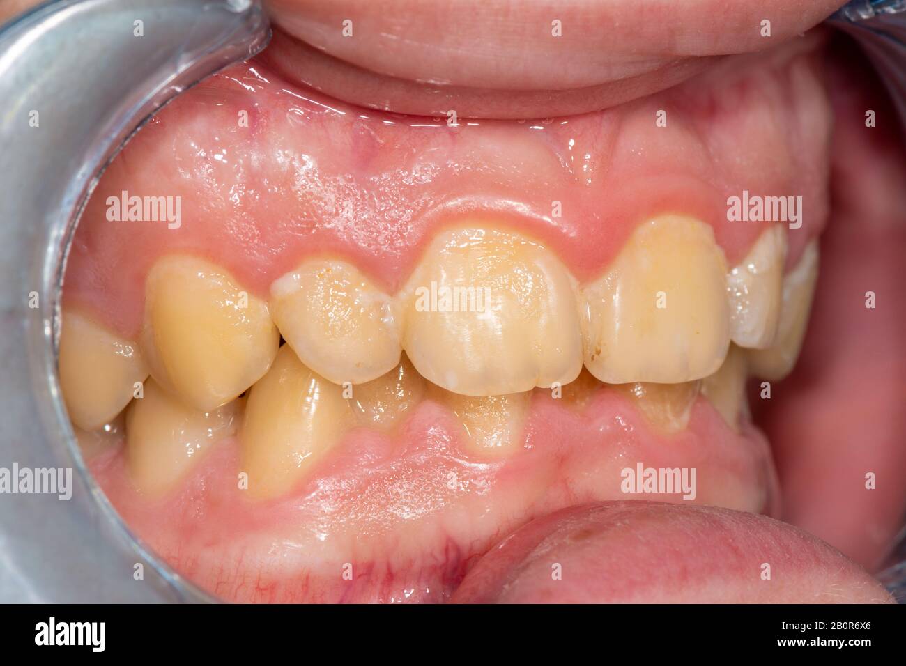 Lower Anterior Teeth