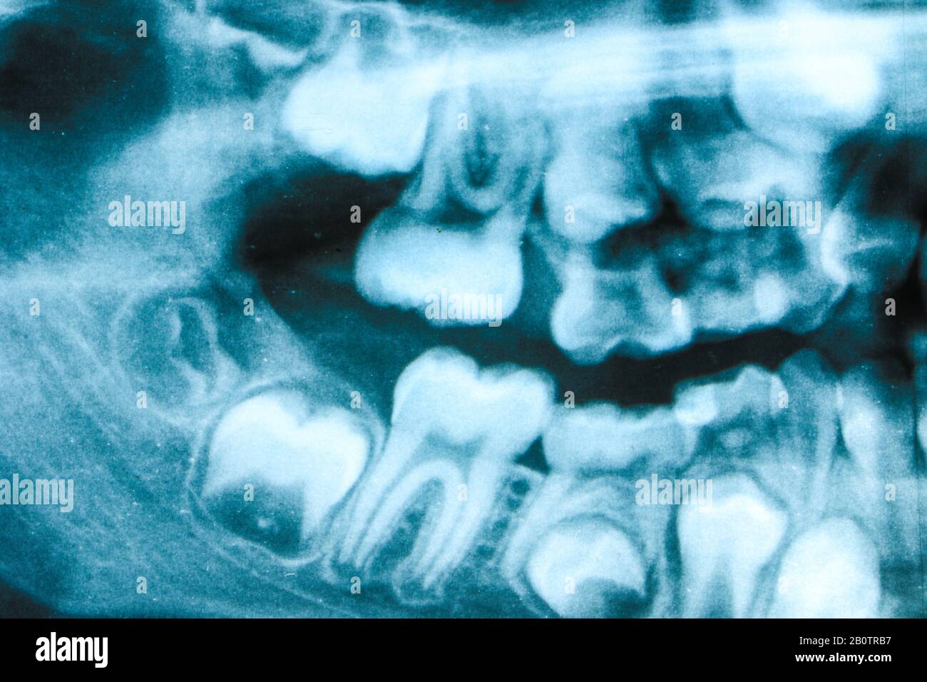 xray of milk teeth Stock Photo - Alamy