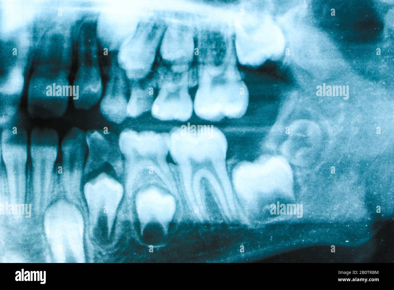 Milk teeth health hi-res stock photography and images - Alamy