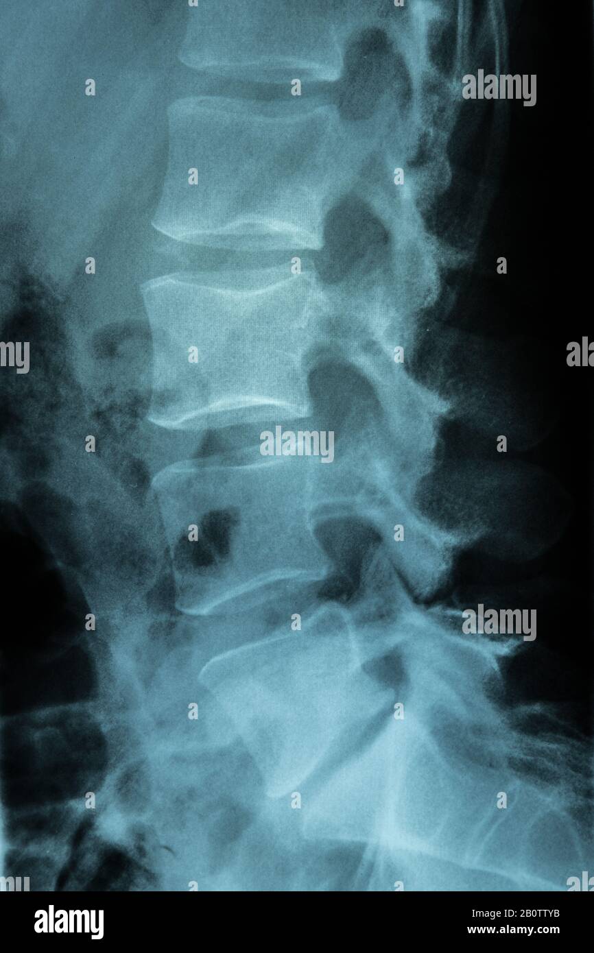 backbone xray scan Stock Photo - Alamy