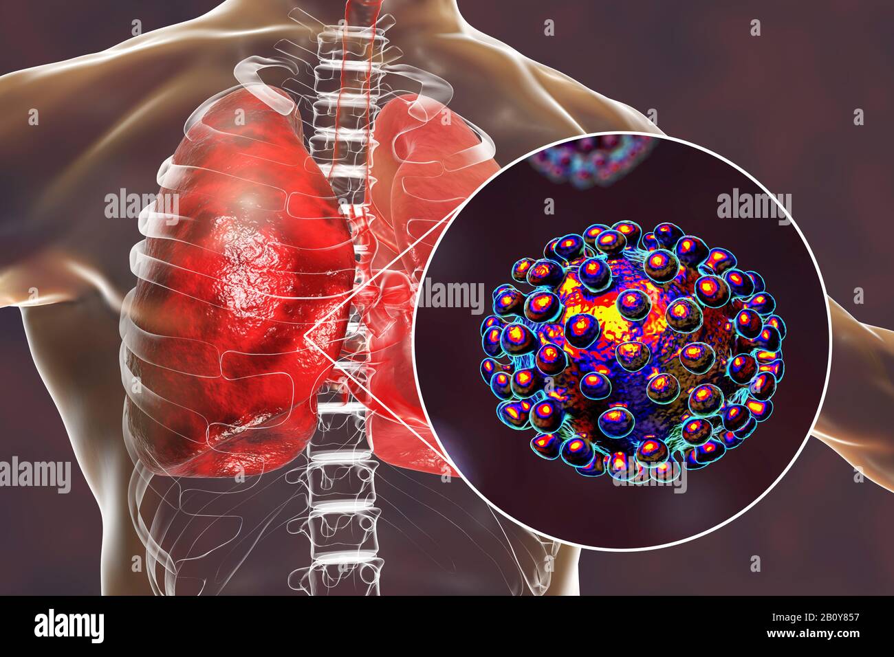 Coronaviruses causing pneumonia, illustration Stock Photo - Alamy