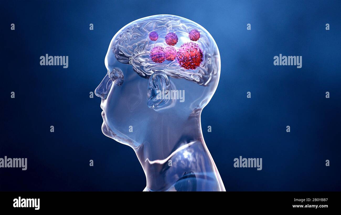 Brain cancer, conceptual illustration Stock Photo - Alamy