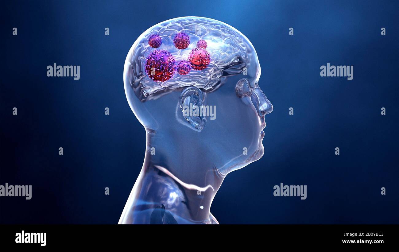 Brain cancer, conceptual illustration Stock Photo - Alamy