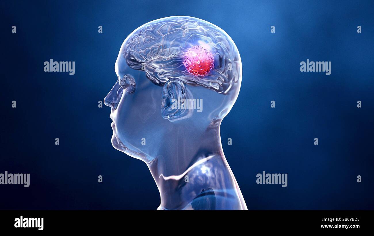 Brain cancer, conceptual illustration Stock Photo - Alamy