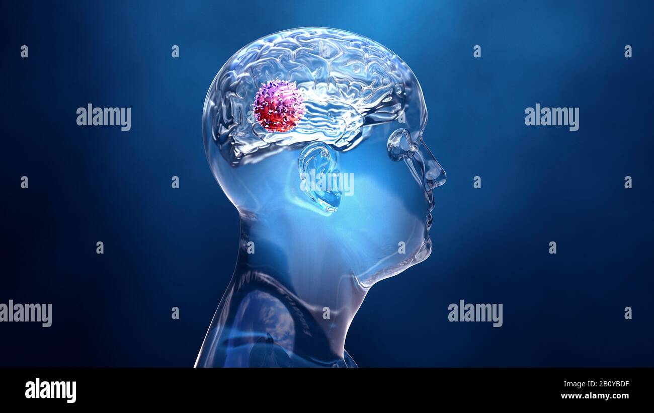 Brain cancer, conceptual illustration Stock Photo - Alamy