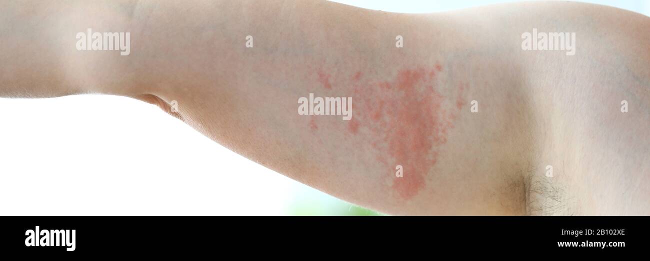 Painful allergic rush Stock Photo - Alamy