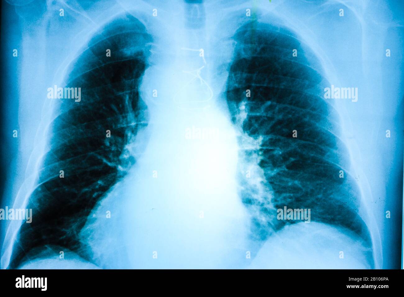 chest thorax xray scan Stock Photo - Alamy