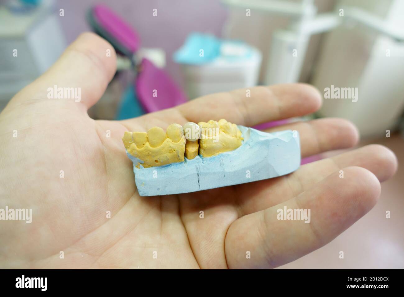 close-up ceramic tooth crown on a plaster model of teeth in the dentist ...