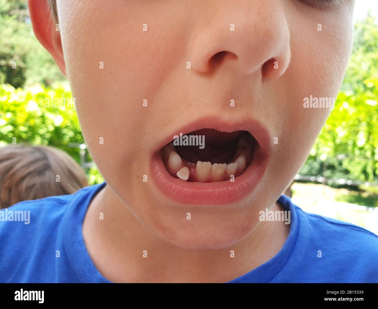 Loose front tooth hi-res stock photography and images - Alamy