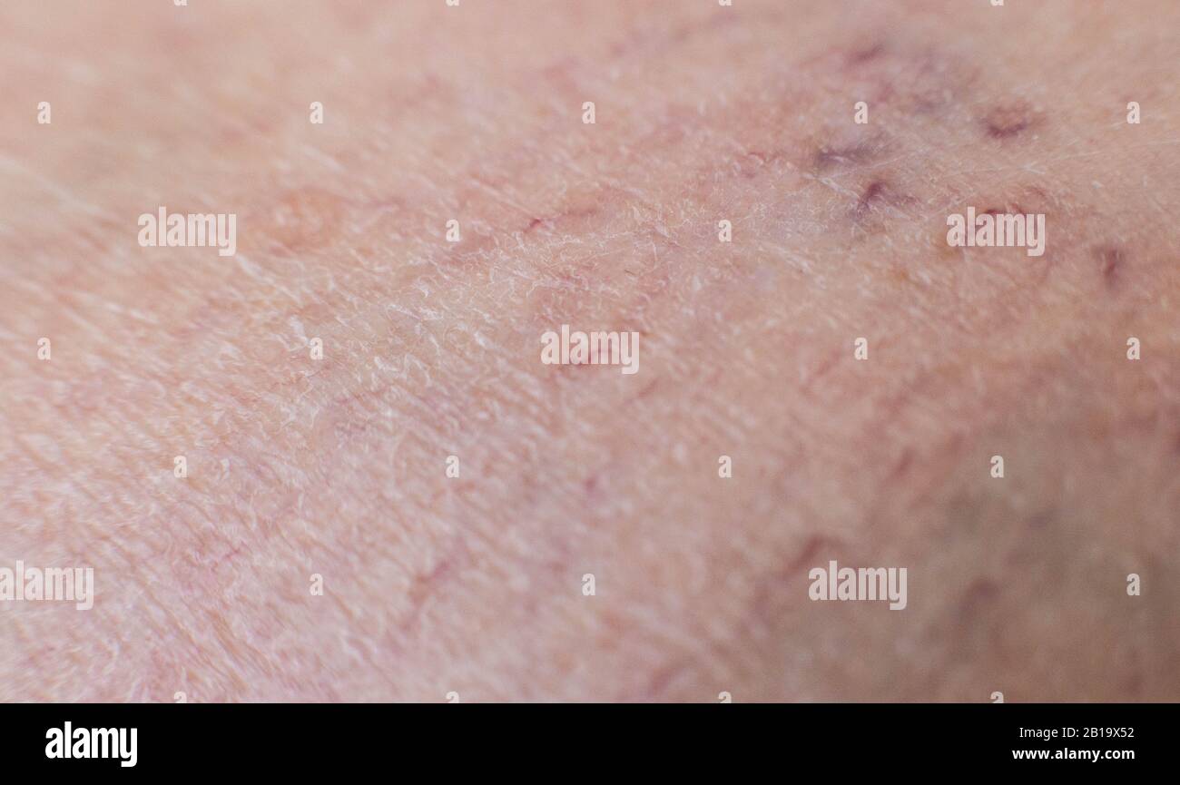 Vascular asterisk on the patient s skin. The concept of varicose veins ...