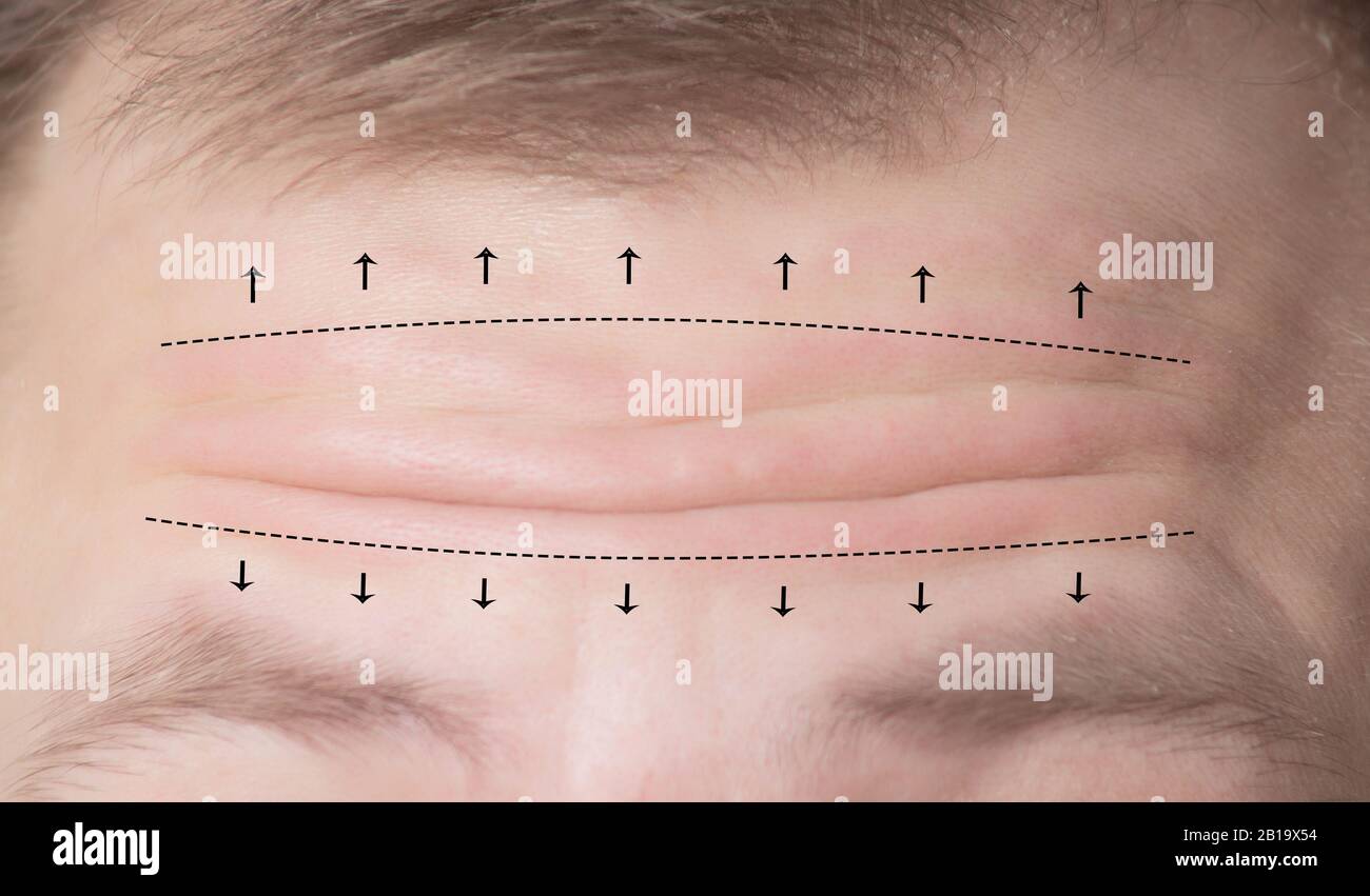 Close-up of male forehead with wrinkles and markers for surgery ...