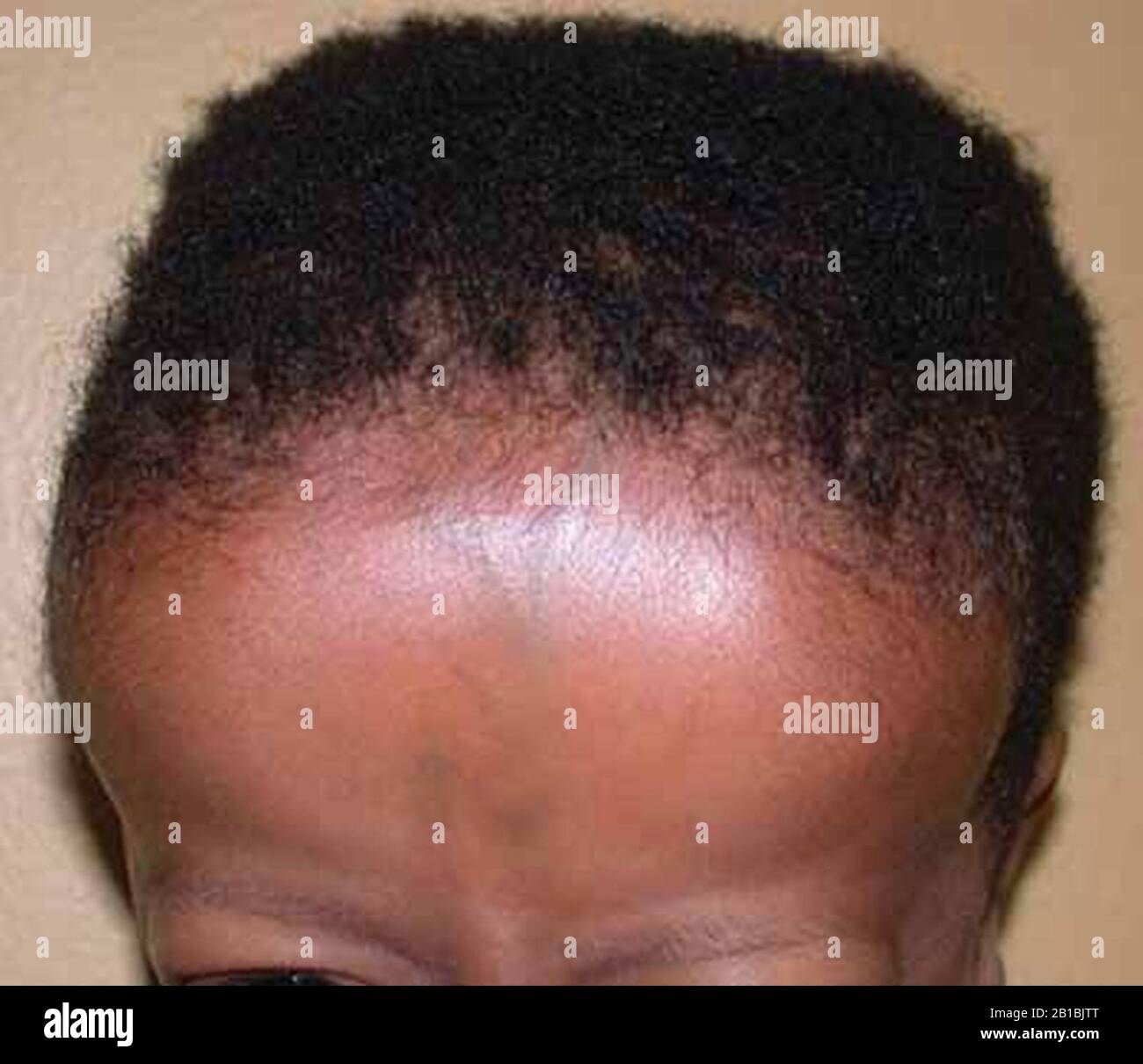 Frontal bossing-in a child Stock Photo - Alamy