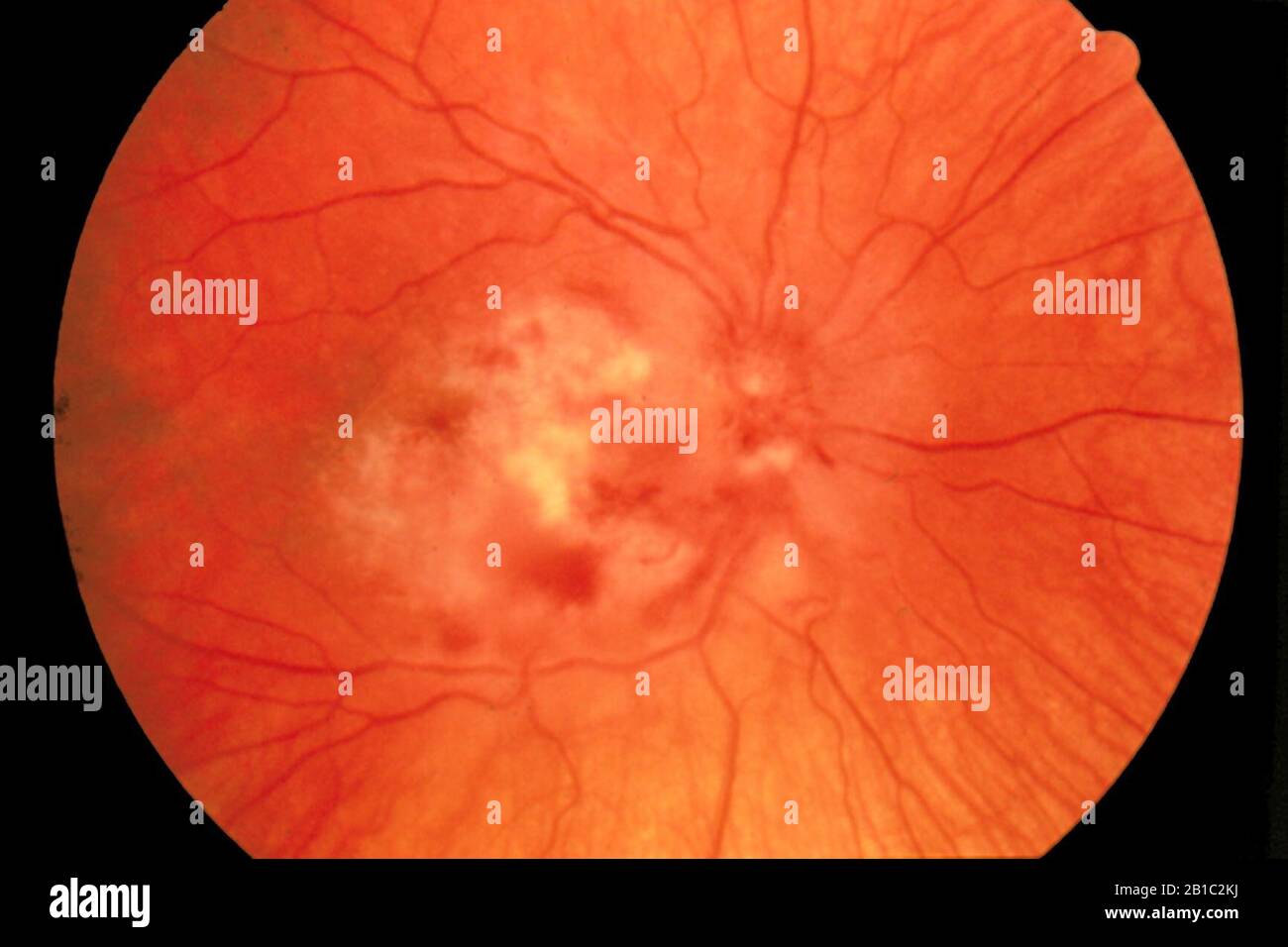 Cytomegalovirus Retinitis Signs