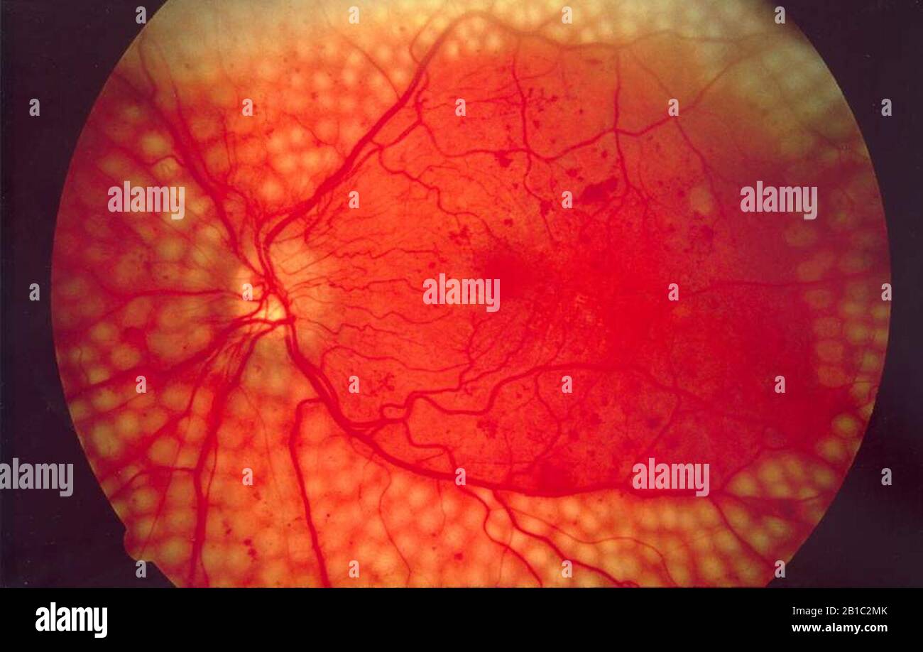 Fundus photo showing scatter laser surgery for diabetic retinopathy ...