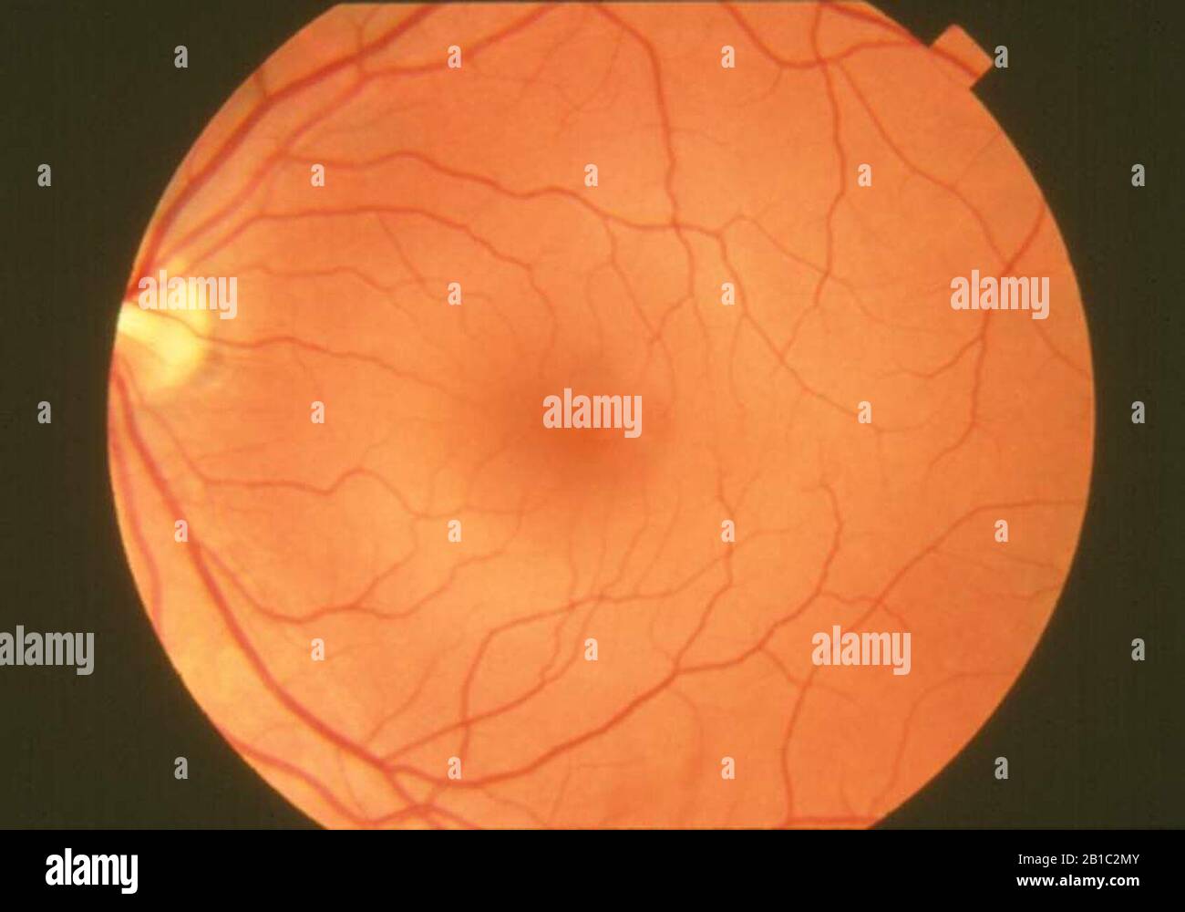 Fundus photograph-normal retina EDA06 Stock Photo - Alamy