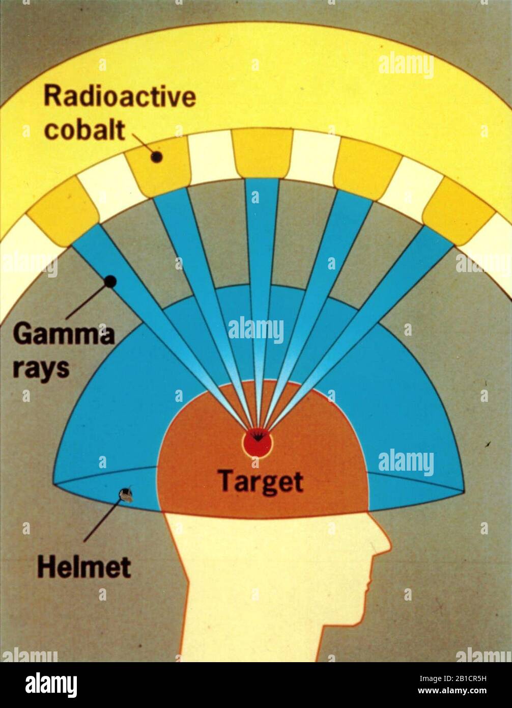Gamma knife hi-res stock photography and images - Alamy