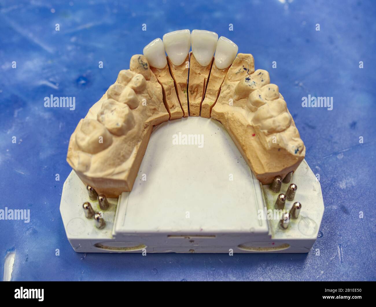 Dentist or dental technician workplace for placing fixed partial ...