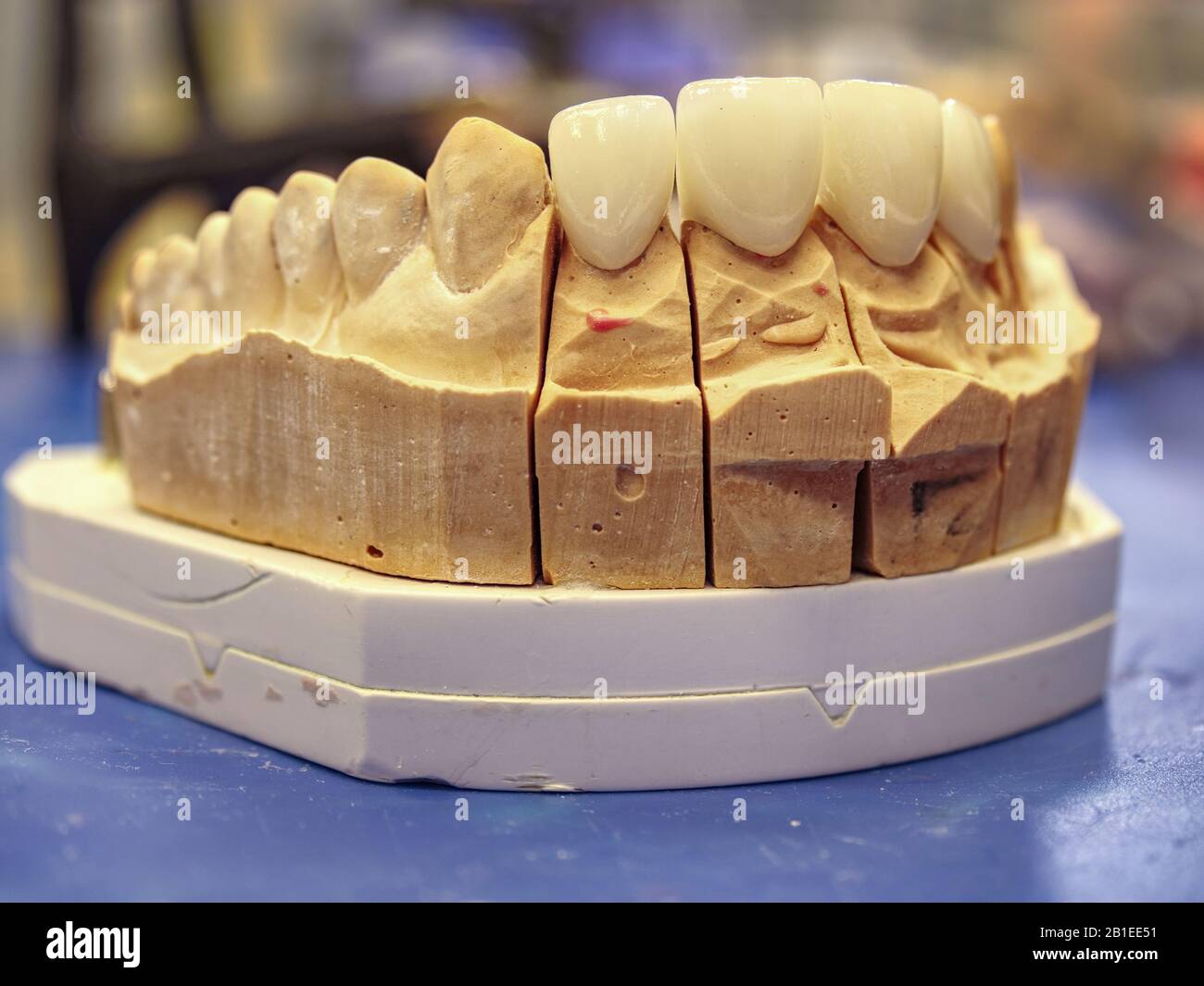 Ceramic-metal crowns and partial ceramic-metal bridge. Replacement of ...