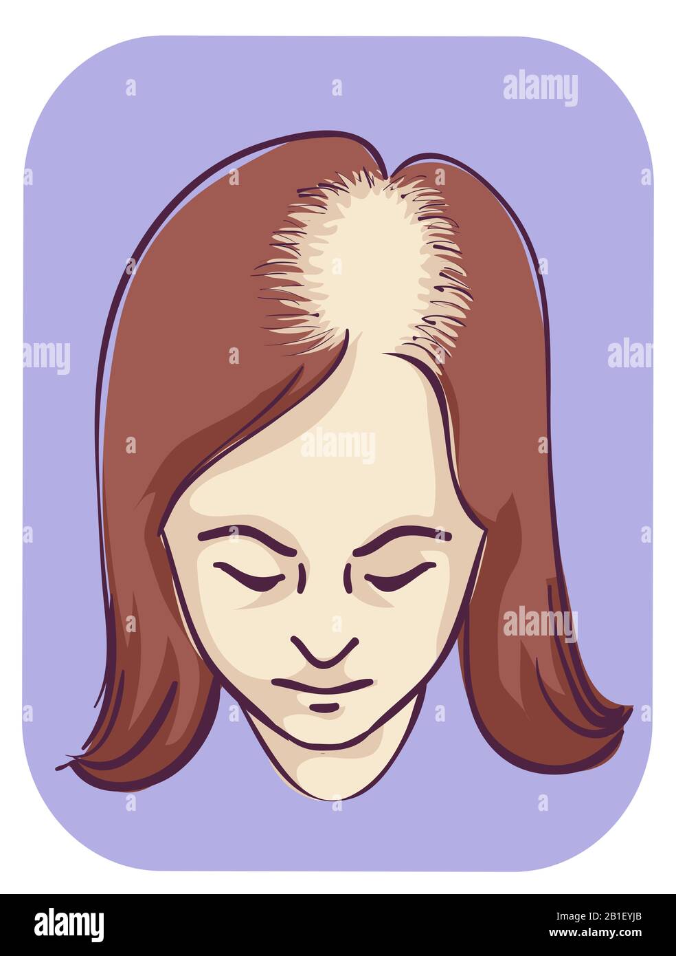 Illustration of a Girl with Female Pattern Baldness, Frontal Scalp ...