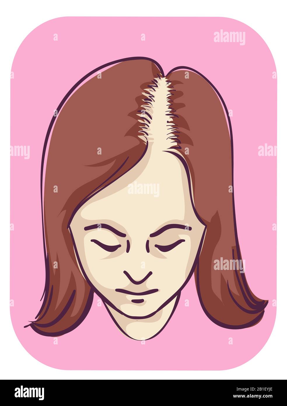 Illustration of a Girl with Female Pattern Baldness, Thinning in the ...