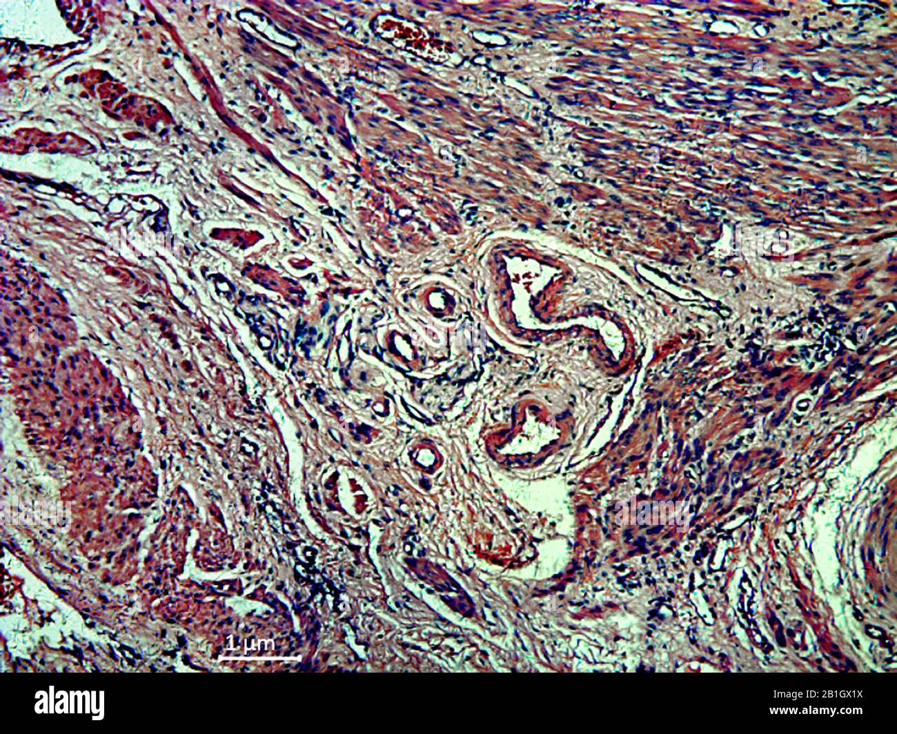 histological cut of tissue of a uterus with Myoma, 500x Stock Photo - Alamy