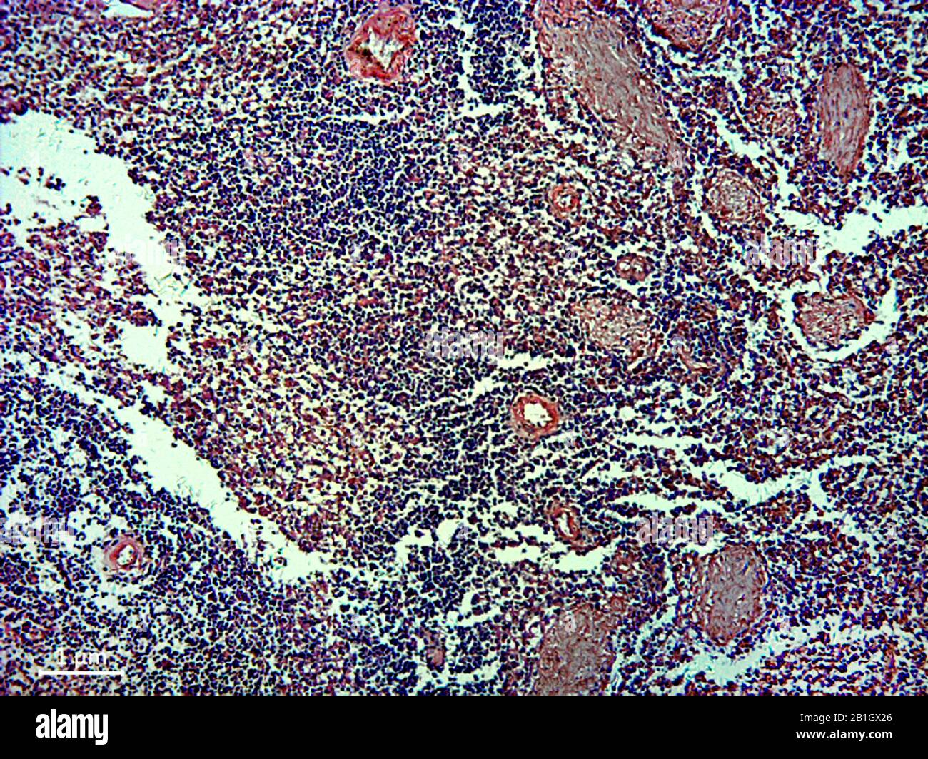 histological cut of tissue of a papillary cystadenoma of an human ovary ...