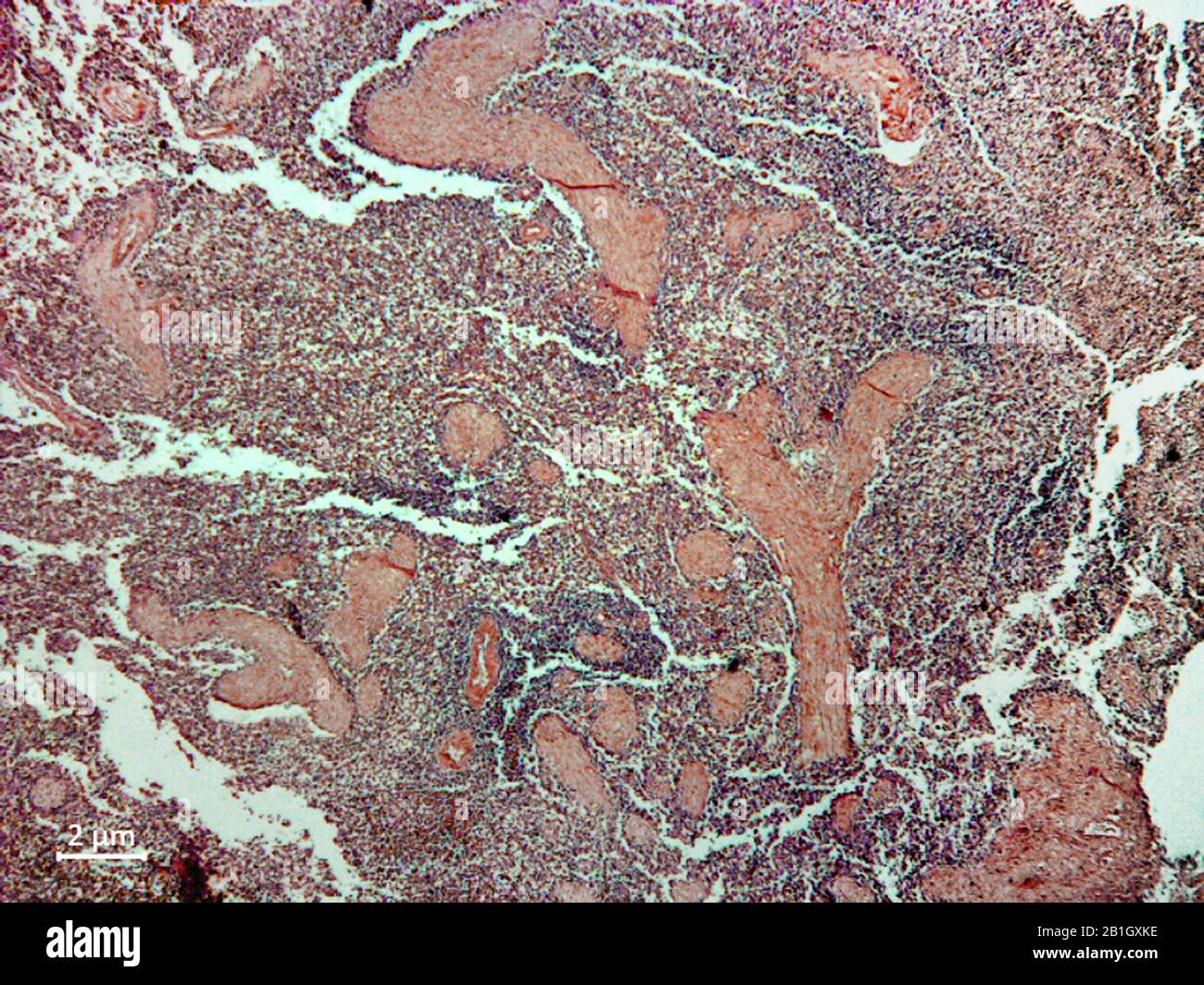 histological cut of tissue of a papillary cystadenoma of an human ovary ...