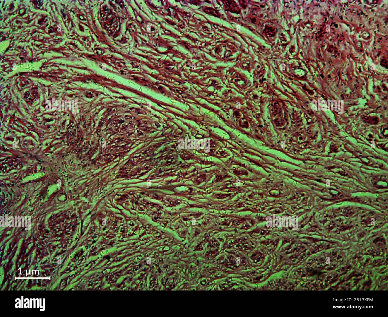 histological cut of tissue of a uterus with Fibroadenoma, 500x Stock ...
